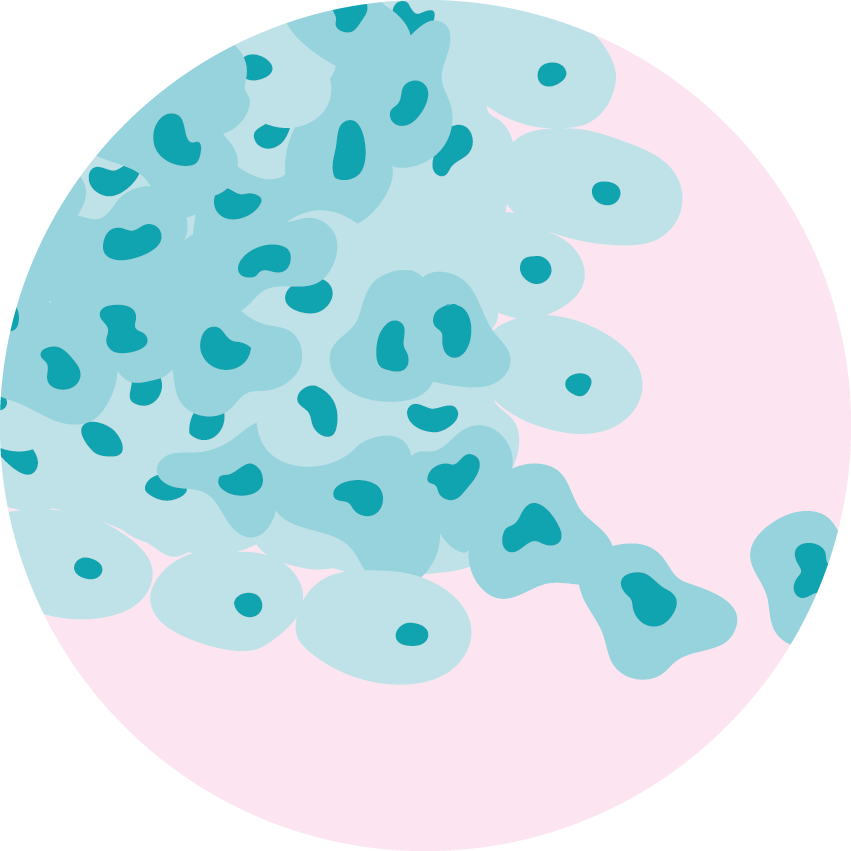 Staging and grading - Prostate Cancer Research