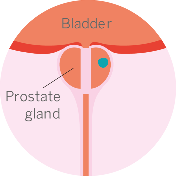 Staging and grading - Prostate Cancer Research