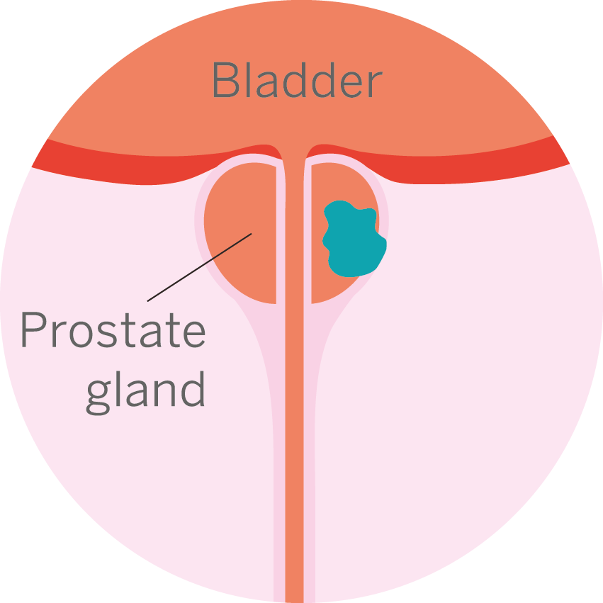Staging and grading - Prostate Cancer Research