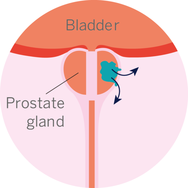 Staging and grading - Prostate Cancer Research