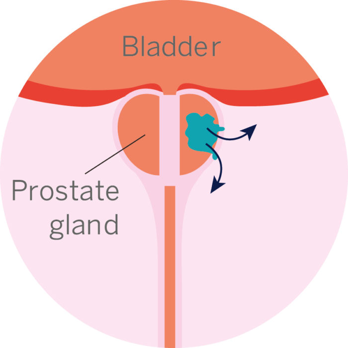 Staging and grading - Prostate Cancer Research